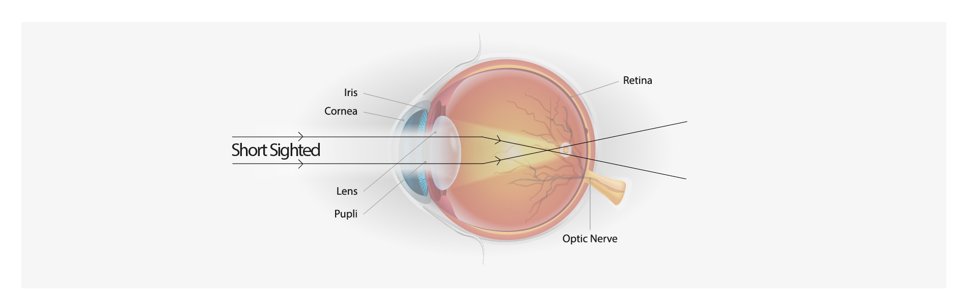 Focus on short sightedness - Patrick & Menzies